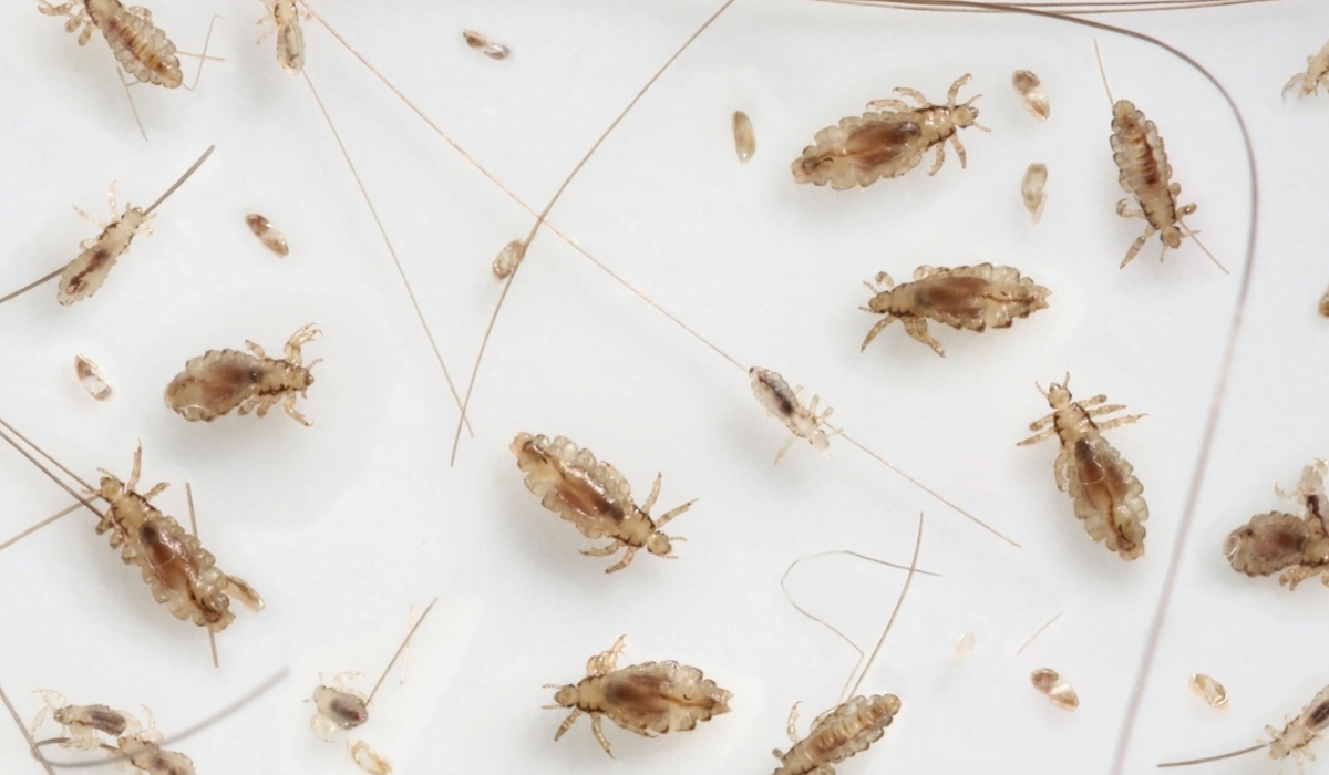 Do Home Remedies For Lice Work Heres A Guaranteed Cure Tct